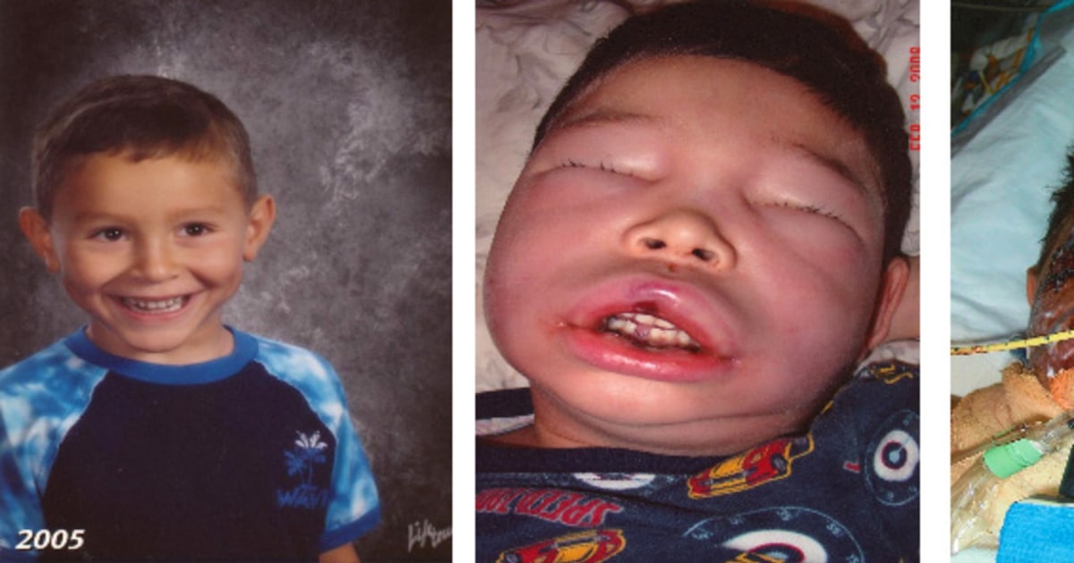 Boy's survival from flesh-eating bacteria deemed a miracle by his ...