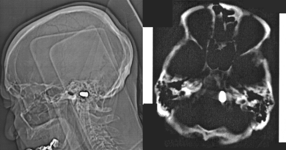 Engineer lived with bullet in his head for 8 decades
