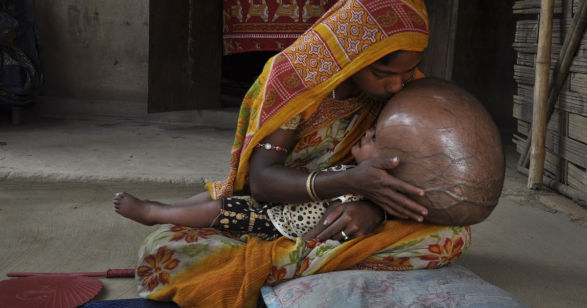 Life-saving surgery for baby with swollen head brings parents joy, relief