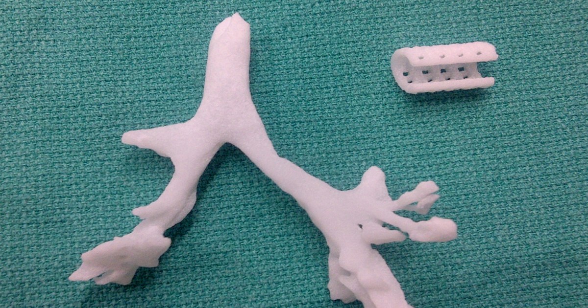 Doctors print up a splint for baby's blocked throat