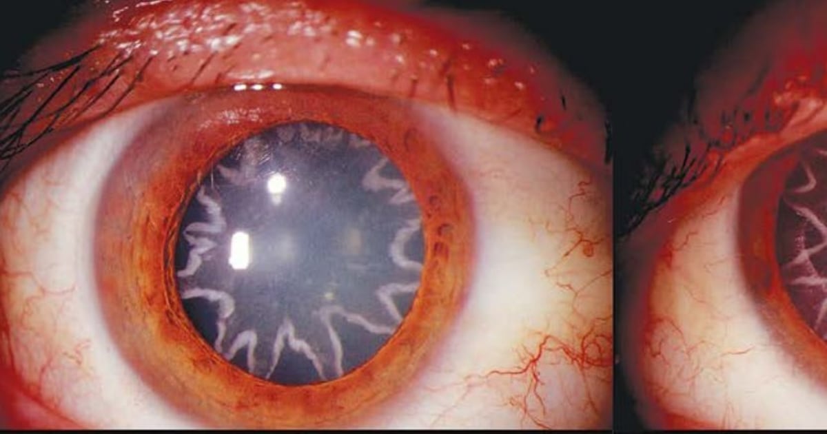 Electrical burn causes star-shaped cataracts in patient's eyes