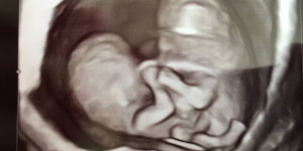 conjoined twins scan