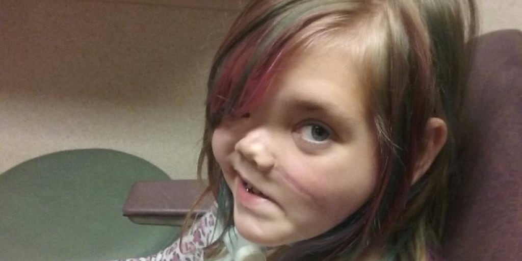 broken cheekbone child