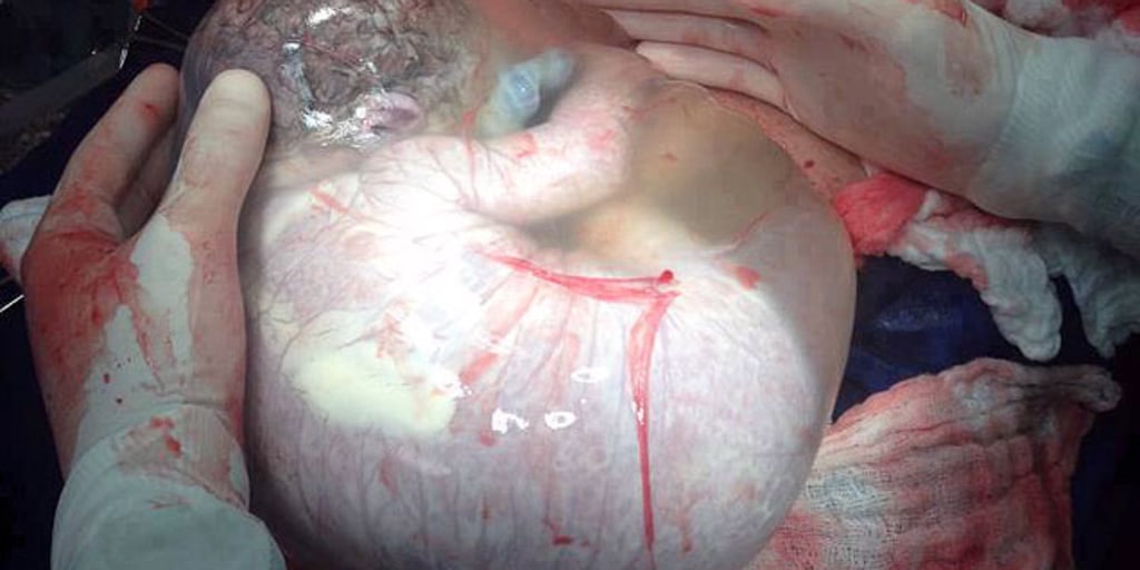 amniotic sac intact