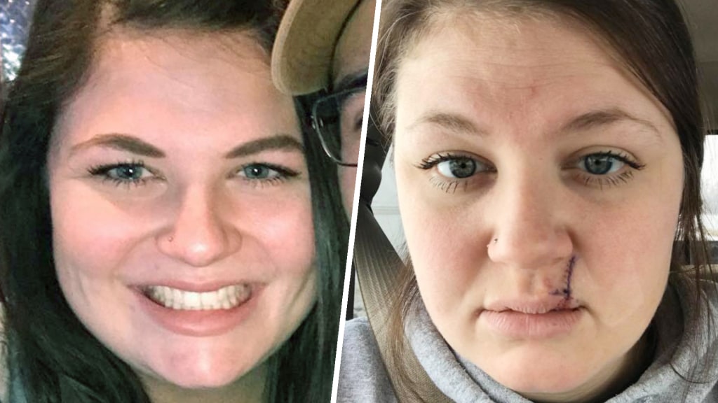 early basal cell carcinoma lip