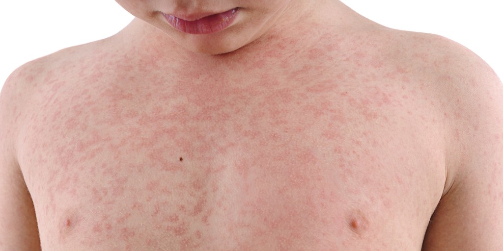 Measles Vaccine Rash The MMR Vaccine Is Safe And Very Effective At