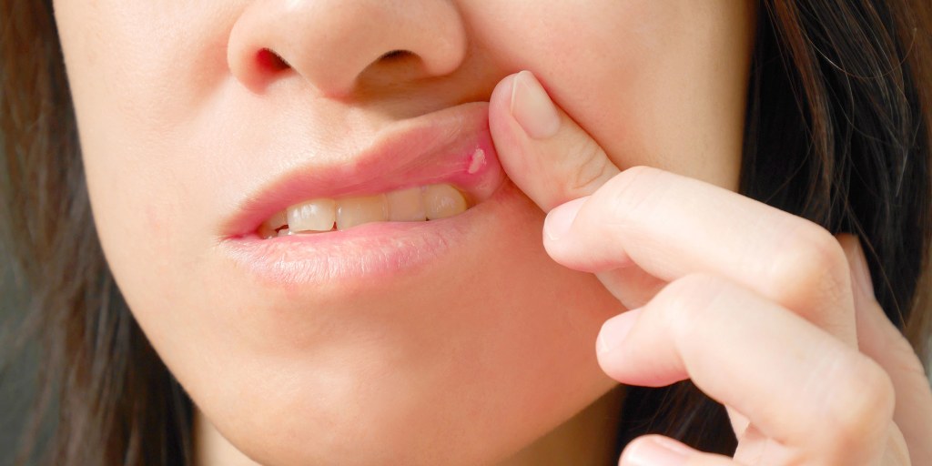 canker sore between lips