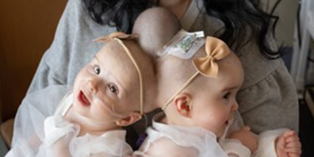 german twins separated