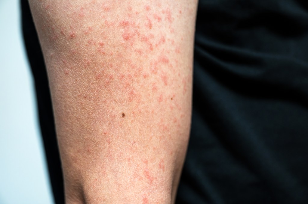 Measles Rash