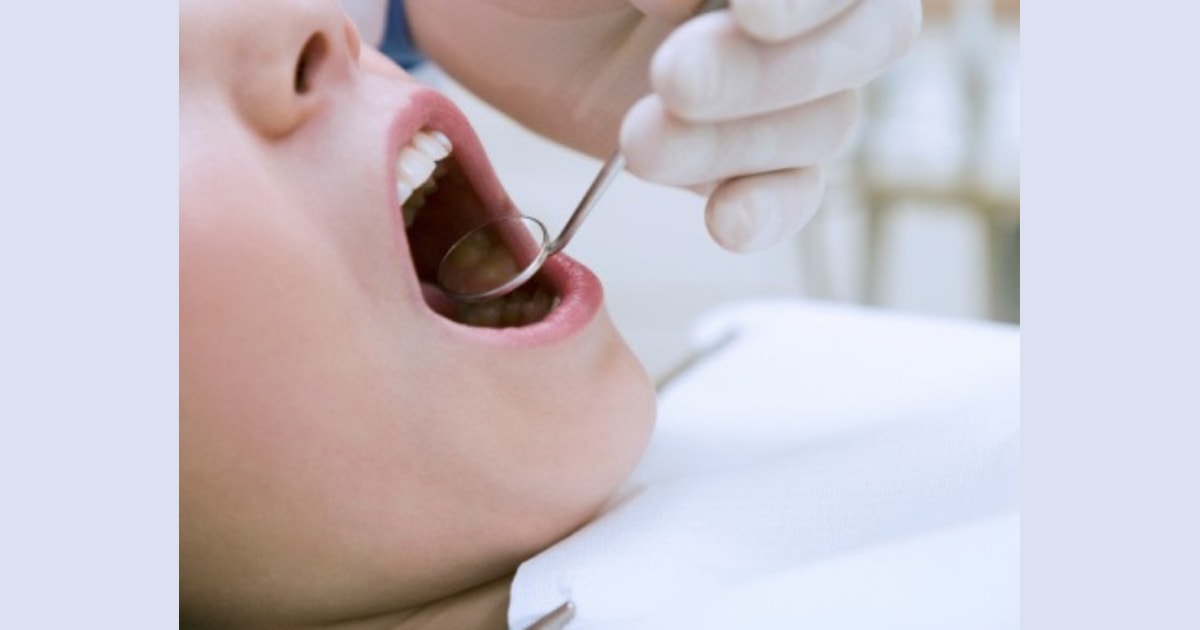 Why so many fillings for baby teeth?