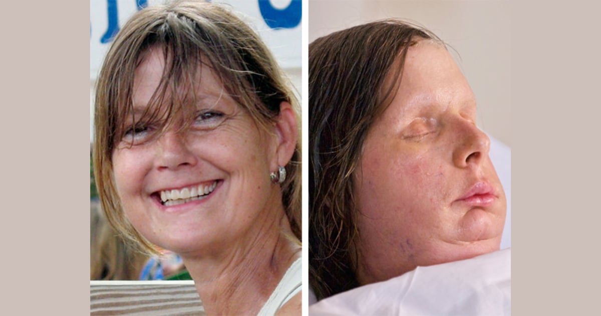 Chimp attack victim’s new face revealed