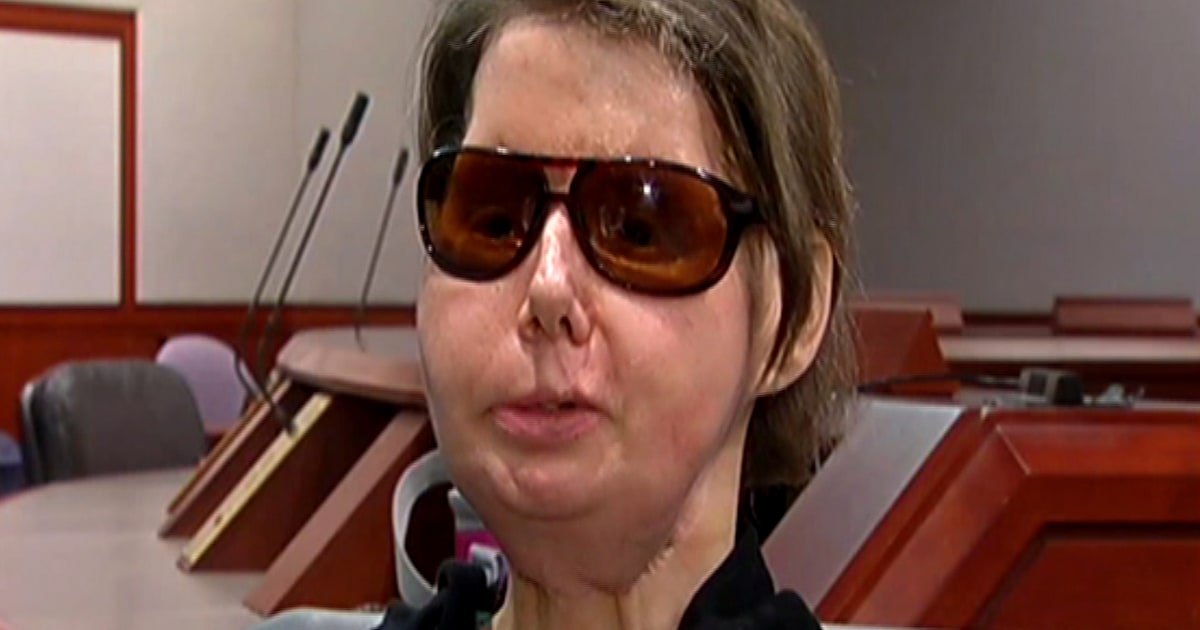 Charla Nash on face transplant: ‘I’m getting more sensation’