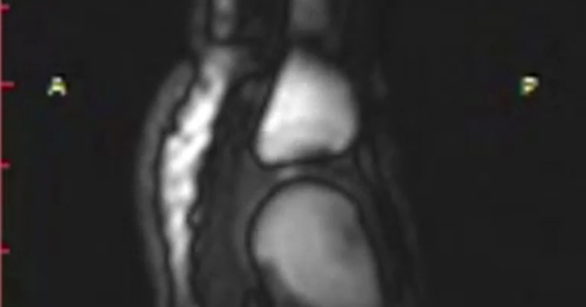 MRI video shows why knuckles crack