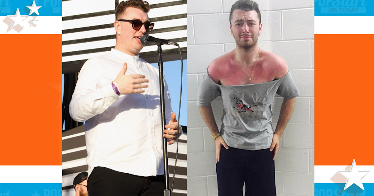 Slim Sam Smith posts painful sunburn, notable weight loss on Instagram