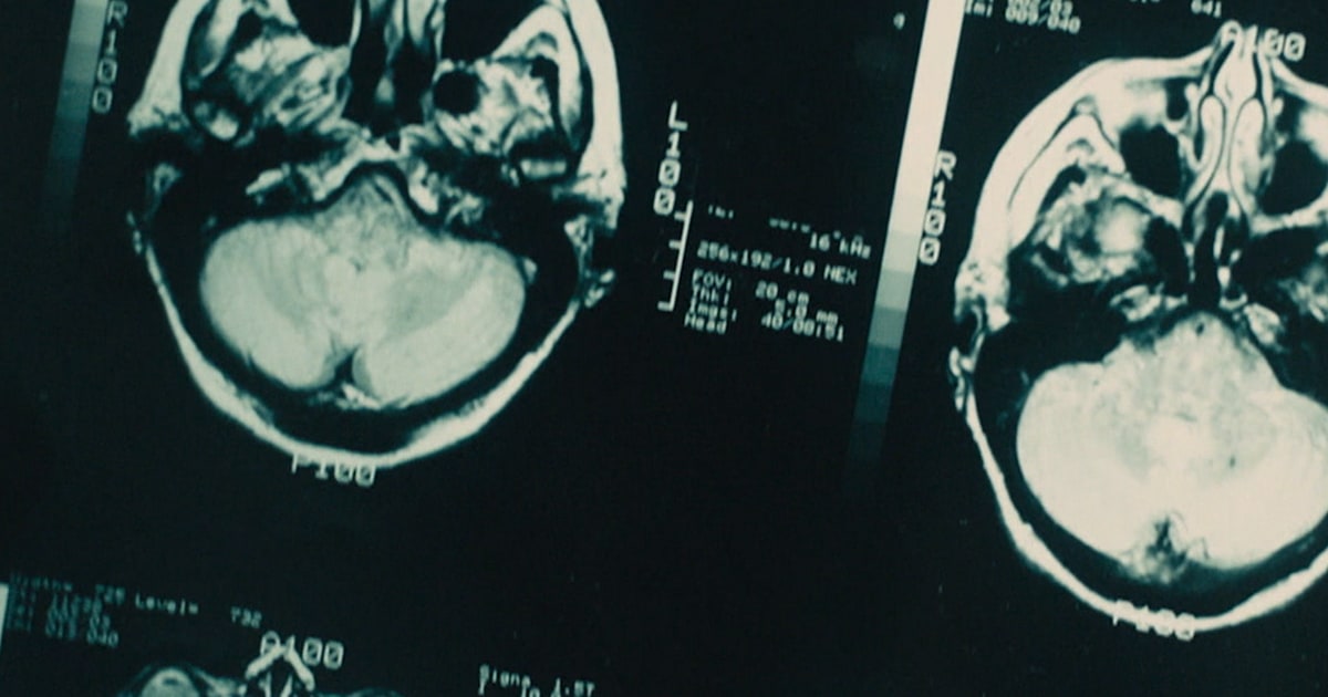 'Concussion' shines light on brain injuries and football