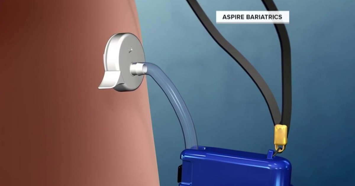 How safe is AspireAssist, the FDA-approved stomach pump weight loss device?