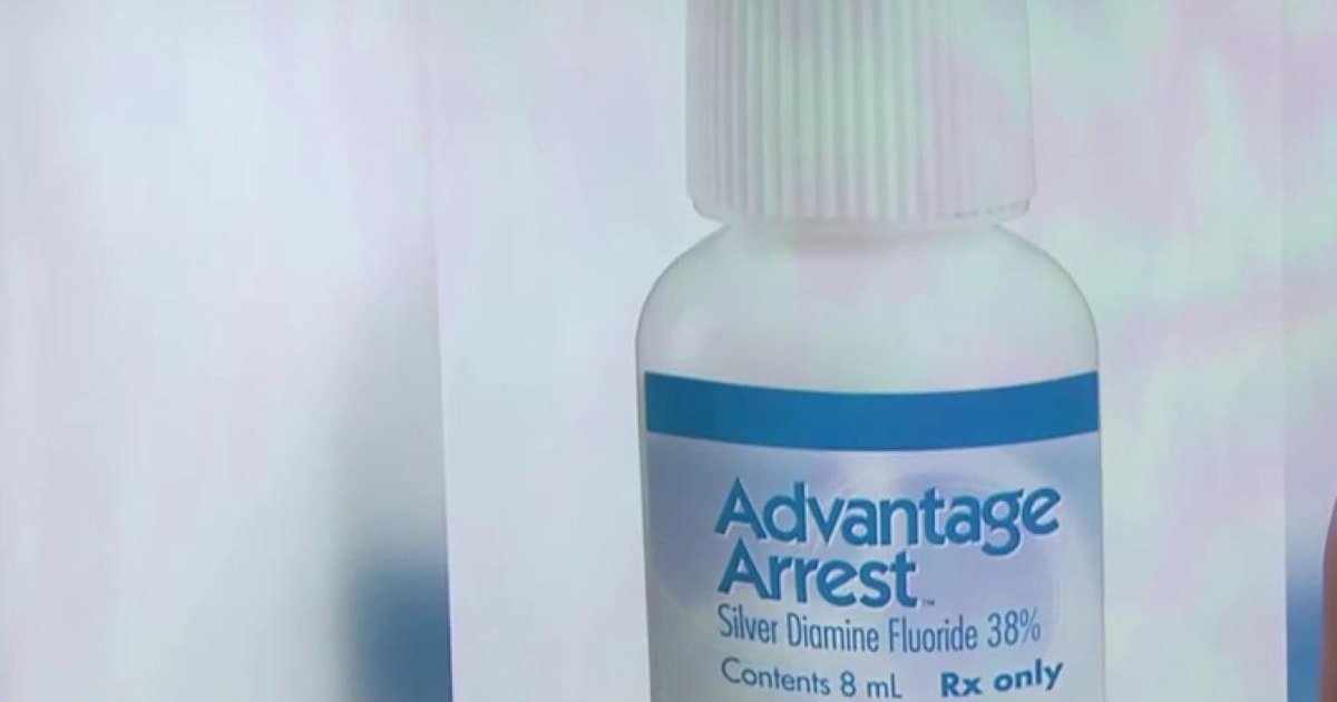 ‘Advantage Arrest’ may make getting cavities drilled obsolete