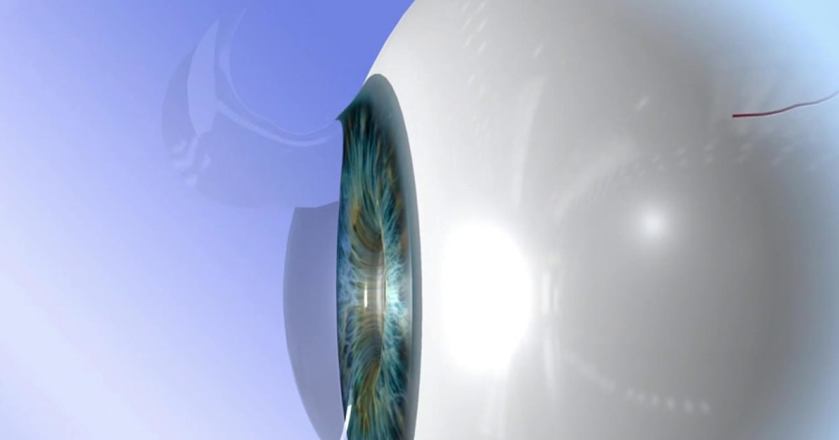 So long, reading glasses? New Raindrop eye implant could make them obsolete