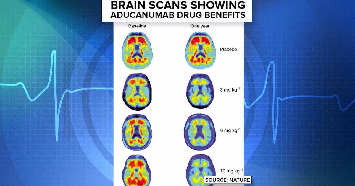 Alzheimer’s breakthrough? Study shows new drug slows memory loss