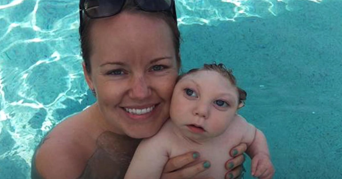 Baby born with part of brain missing thrives at 2