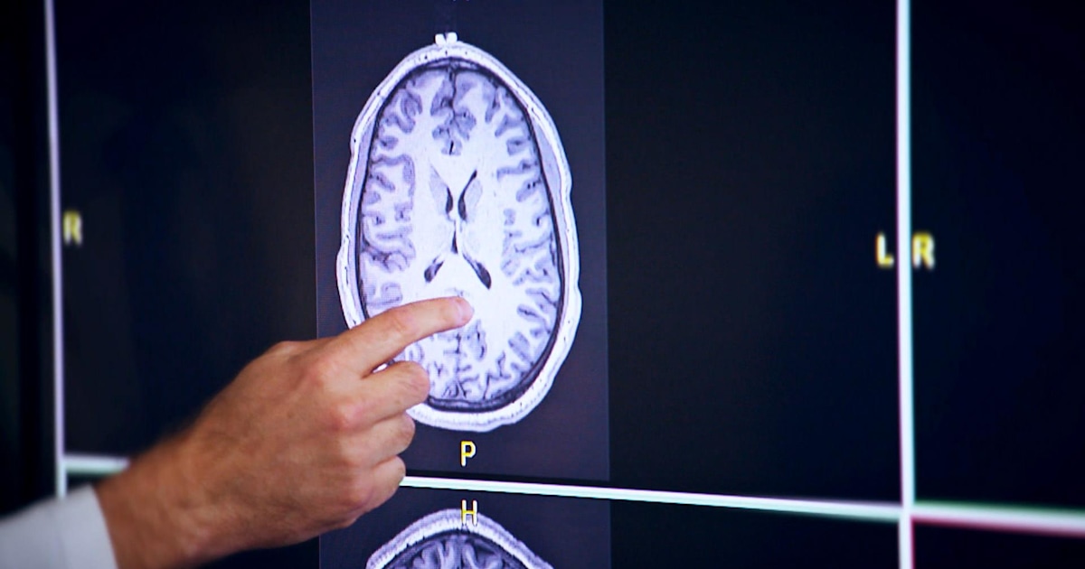 New study finds CTE in 99 percent of deceased NFL players’ brains