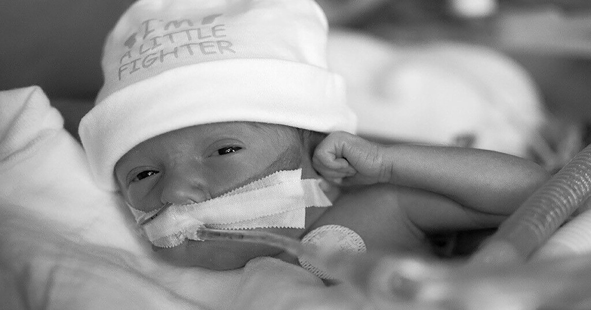 Baby born with organs outside belly celebrates 2nd birthday