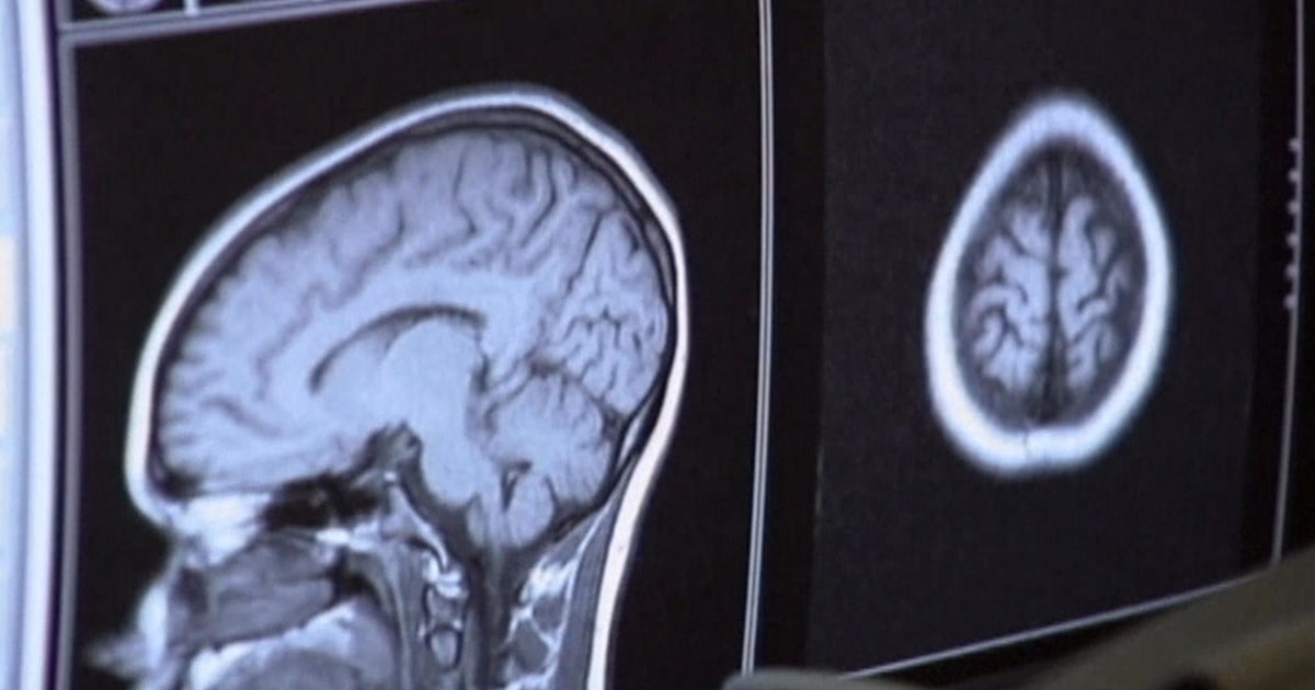 Life after death? Study finds brain still works after body dies