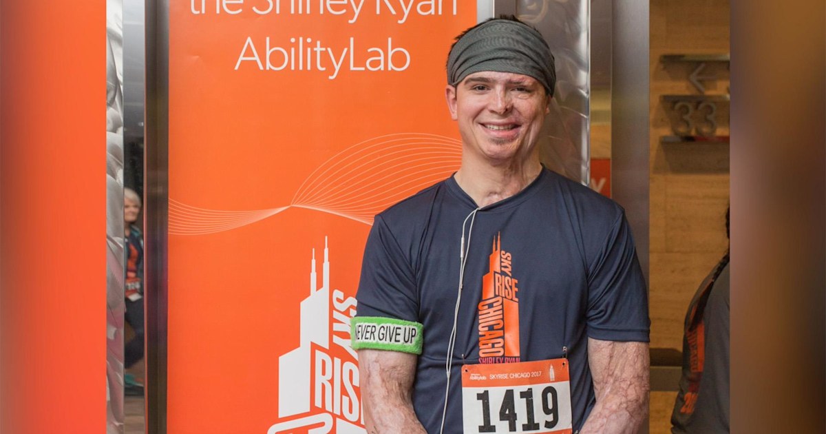 After fire burns more than half of his body, man makes inspiring recovery