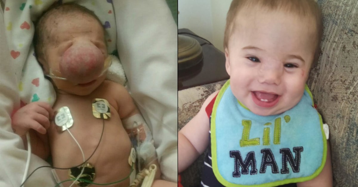 Baby born with sac on face thrives after surgery