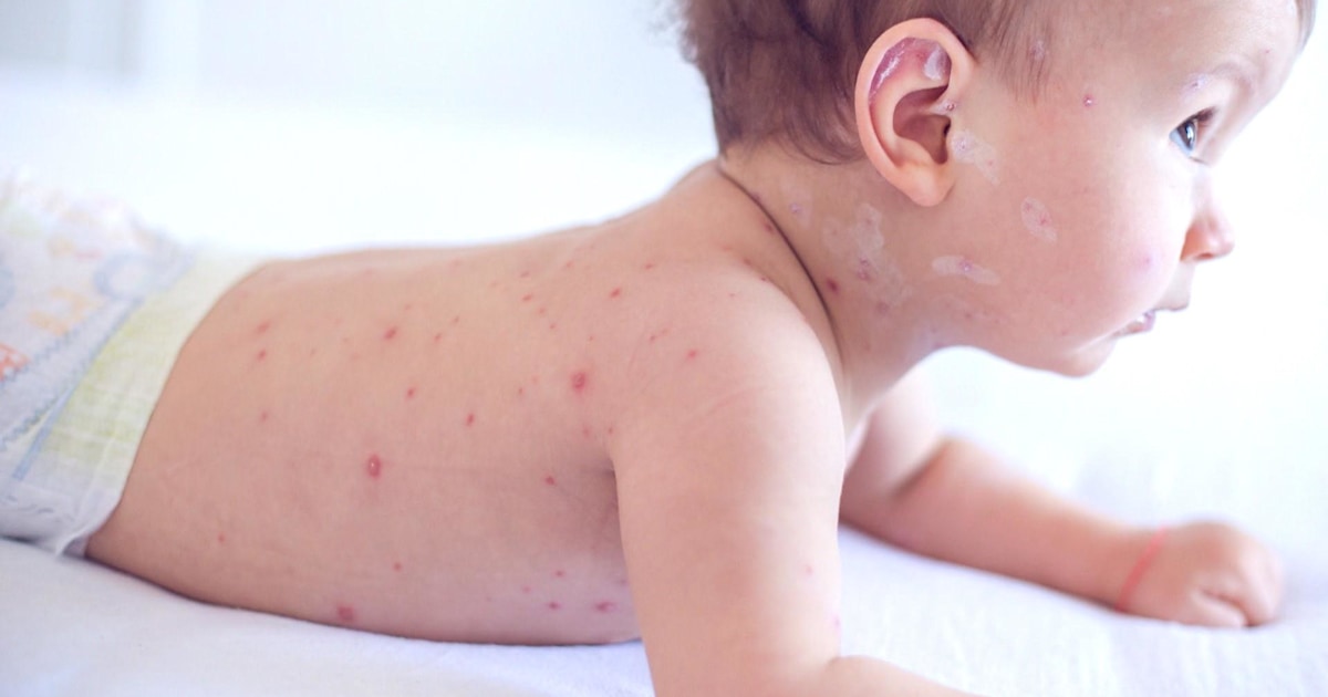 Measles cases in US climbs to highest levels in 25 years