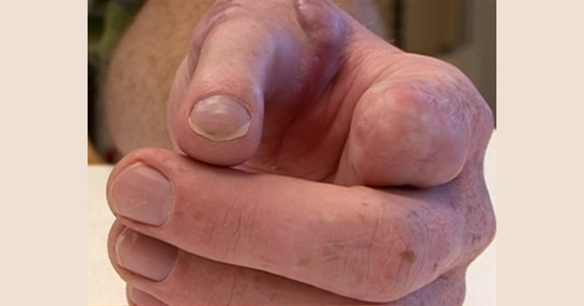 Athlete receives rare toe-to-thumb transplant