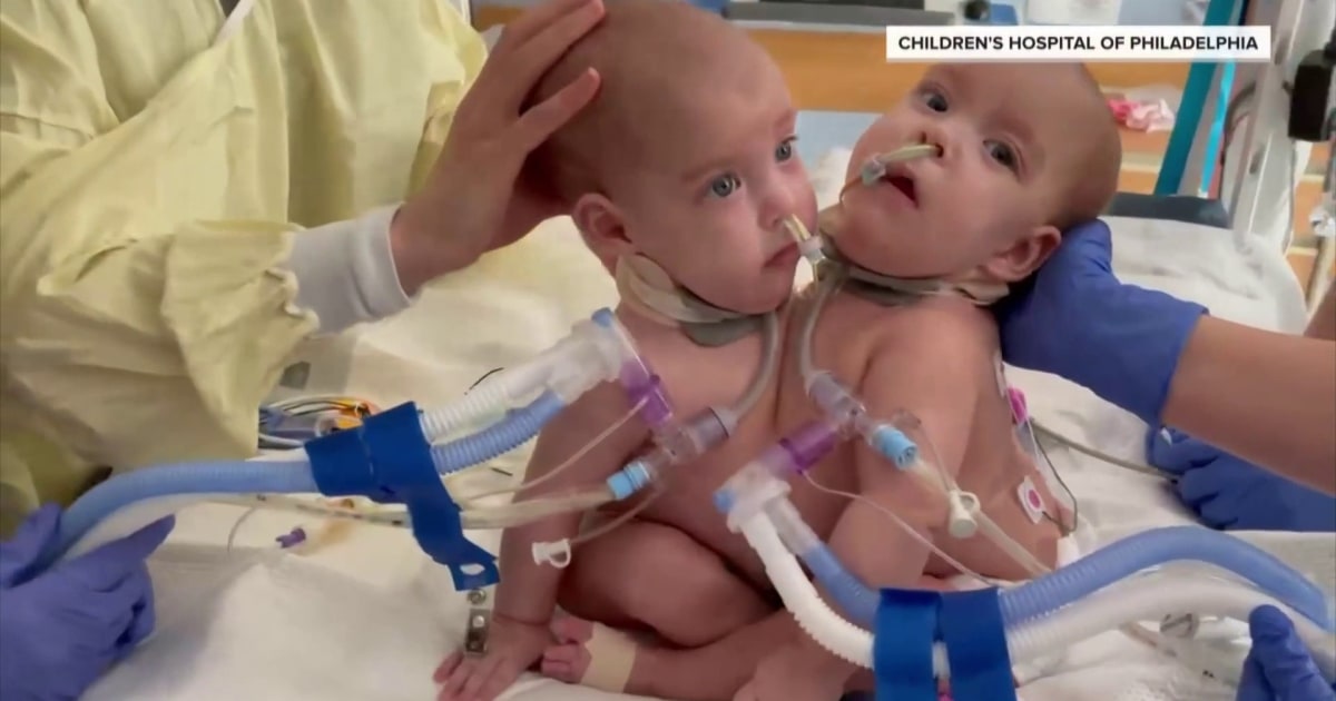 Lead surgeon talks about the teamwork it took to separate conjoined twins
