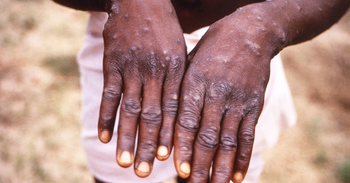 How to identify a monkeypox rash: Symptoms to look out for