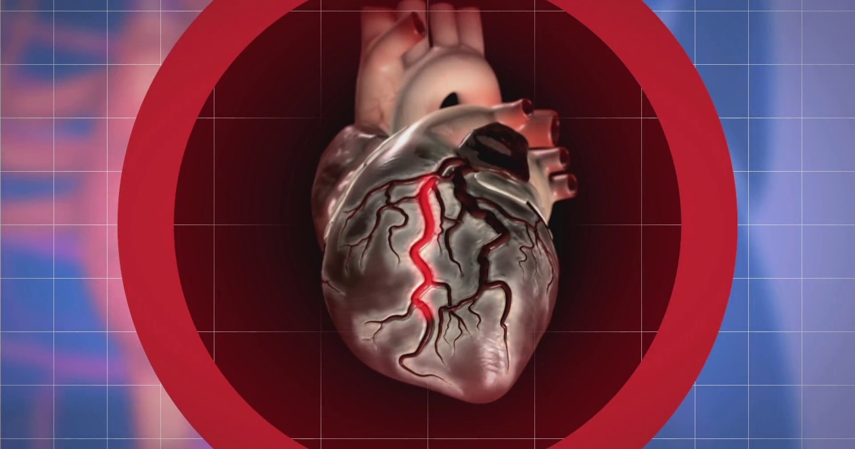 Doctors work to uncover heart attack risk factors in young adults