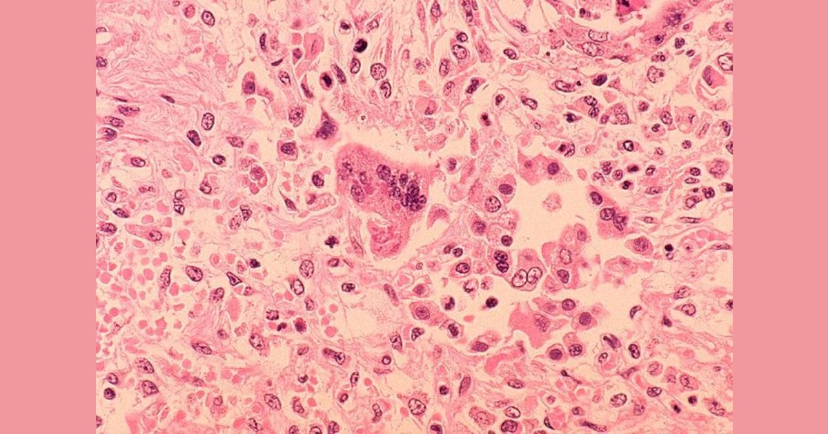 Measles Outbreak Growing - and Immunized Adults Are at Risk
