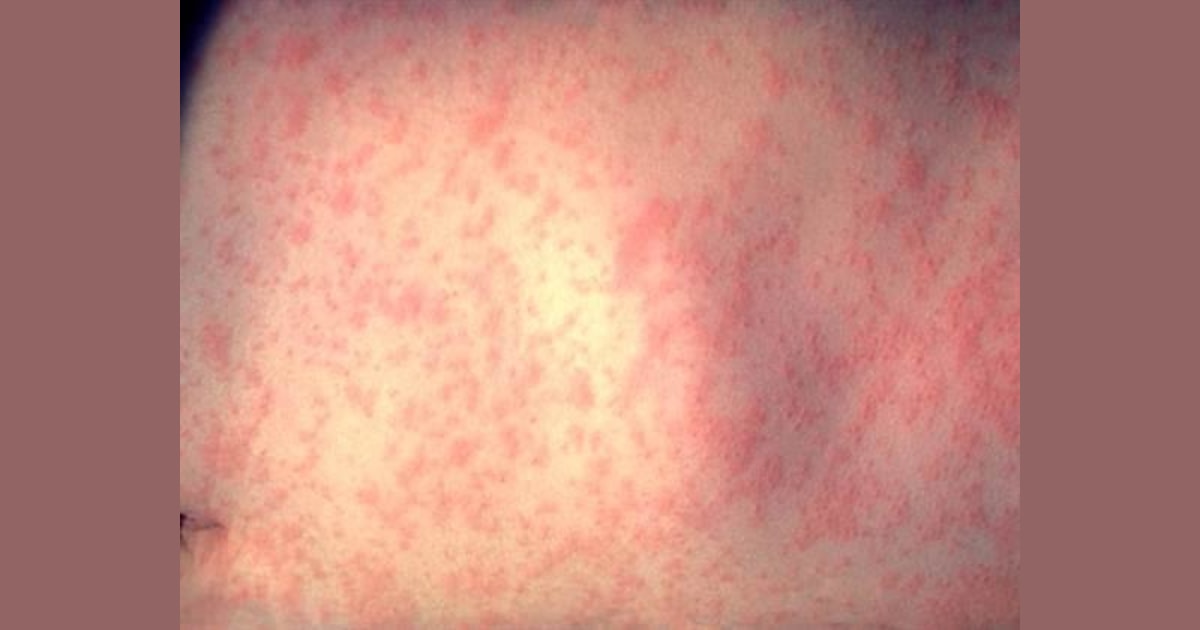 'Measles parties' in California prove false