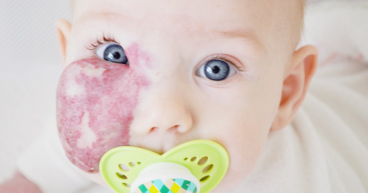 Mom shares photos of daughter with birthmark to erase stigma: 'Hold the ...