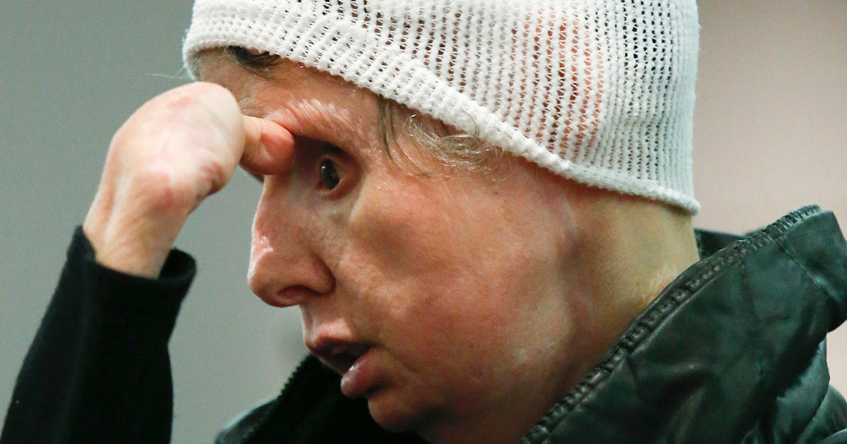 Chimp attack victim Charla Nash's body rejecting face transplant