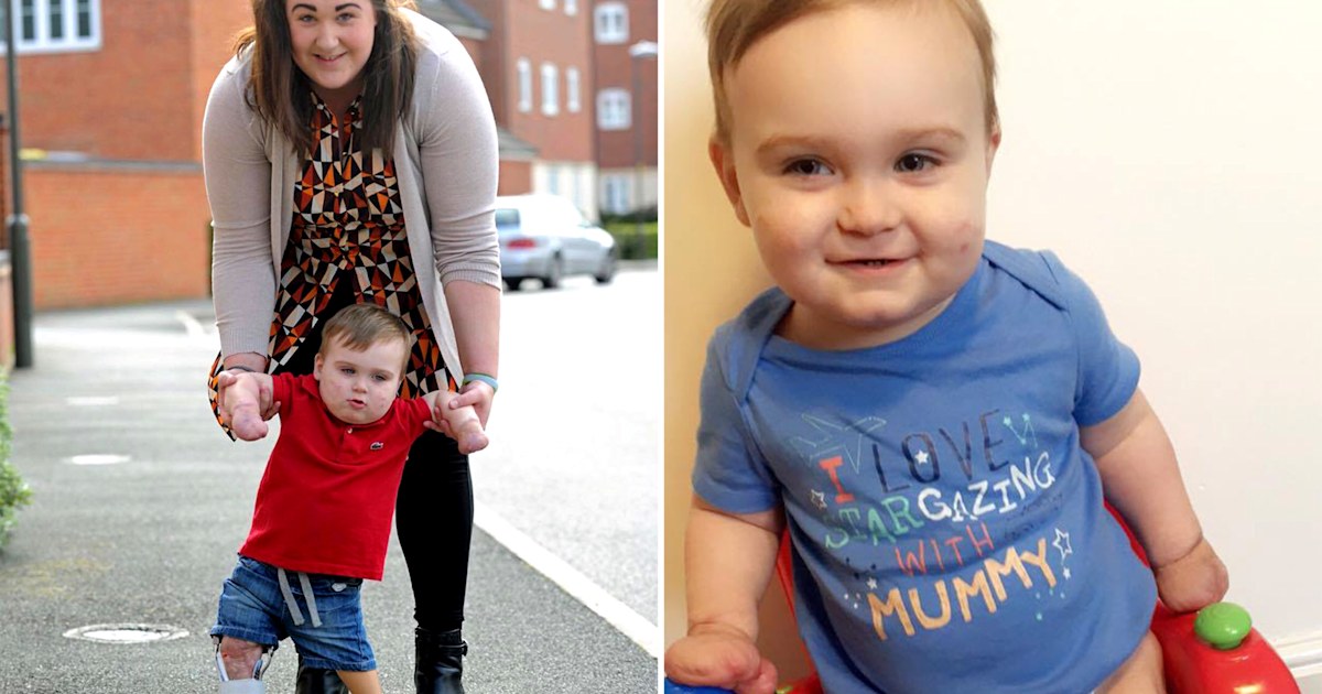 Toddler who lost limbs to meningitis takes first steps, doing 'brilliant'