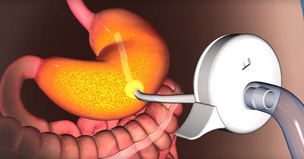 FDA approves weight-loss stomach pump to fight obesity