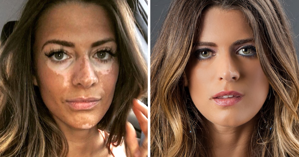 Model Breanne Rice reveals vitiligo condition in powerful post