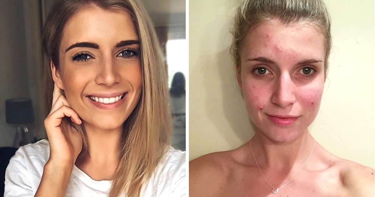 Beck Lomas shares no-makeup selfie with acne: 'No one is completely ...