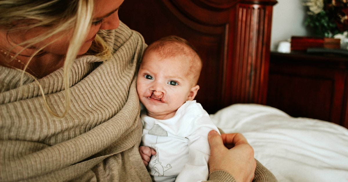 Baby's cleft palate and lip inspires cruelty but also grace