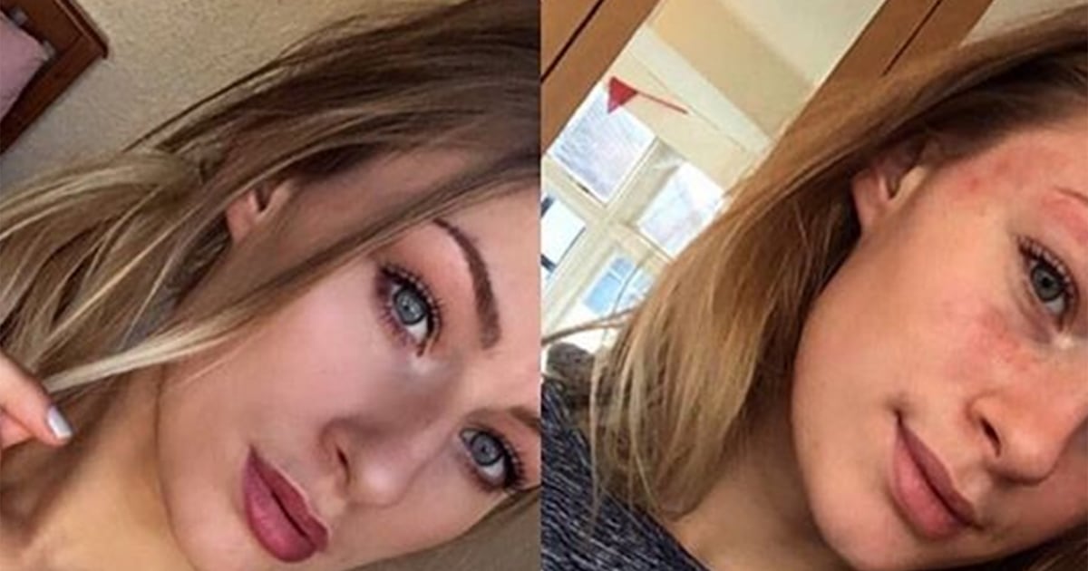 Instagram star Carys Gray opens up about her eczema struggle
