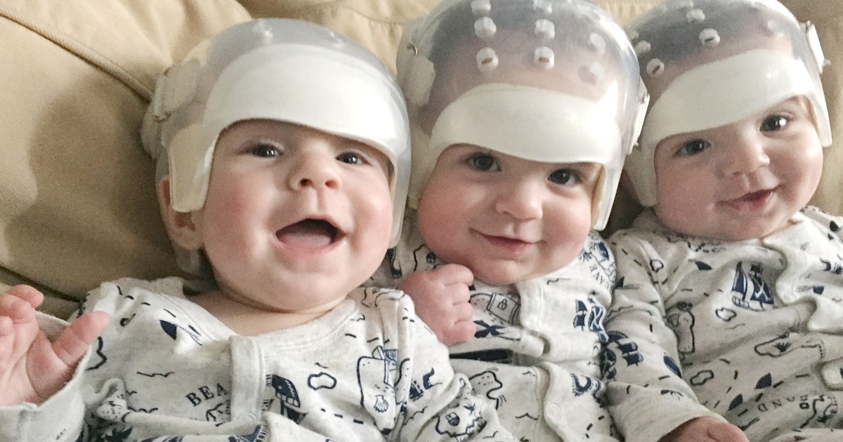 Craniosynostosis: Triplets with skull condition