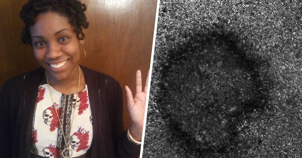 Woman sustains burned retina after looking at solar eclipse