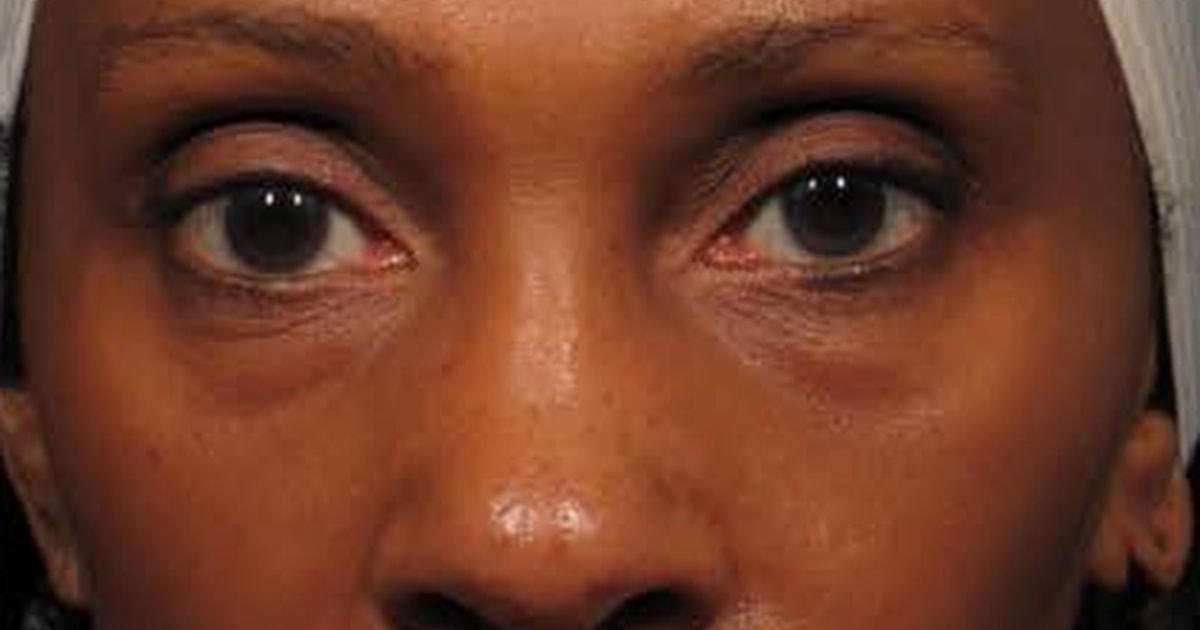 Happy Face Yoga face exercises help women look younger