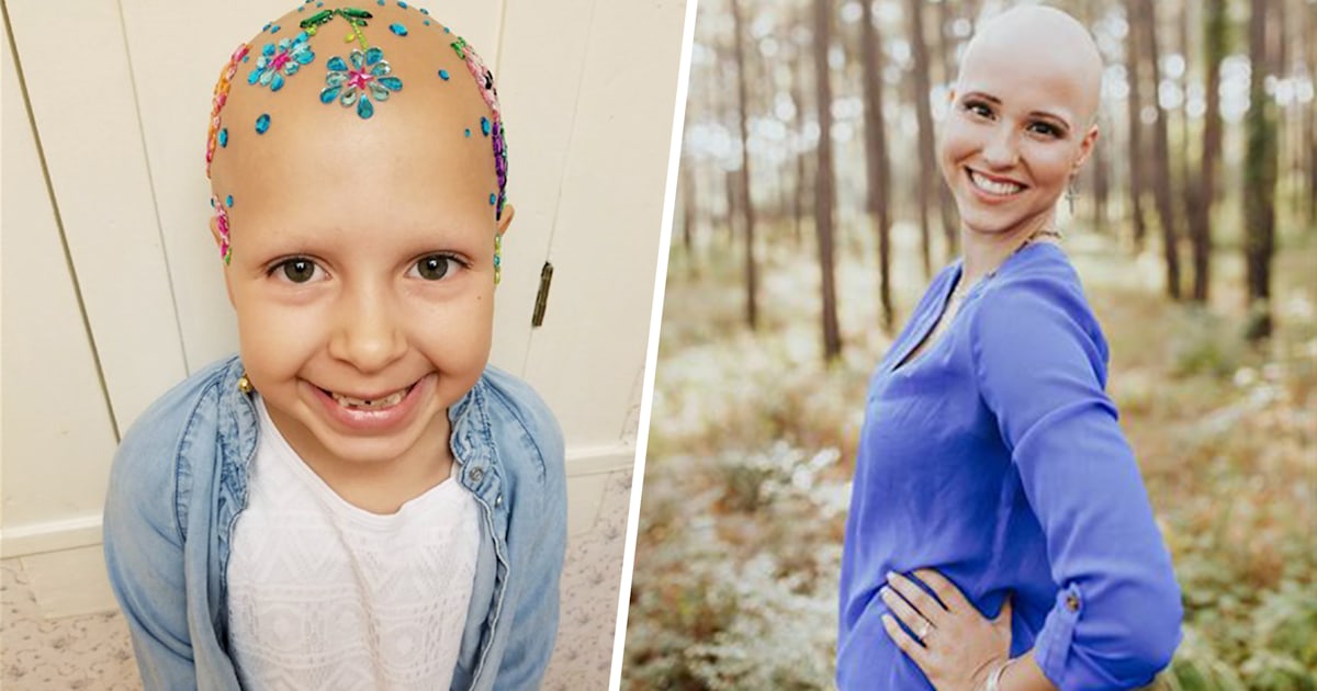 Why some women with alopecia are proudly going without wigs