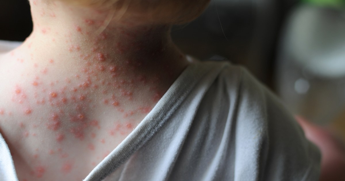 Can chickenpox cause a stroke? Why the vaccine is important