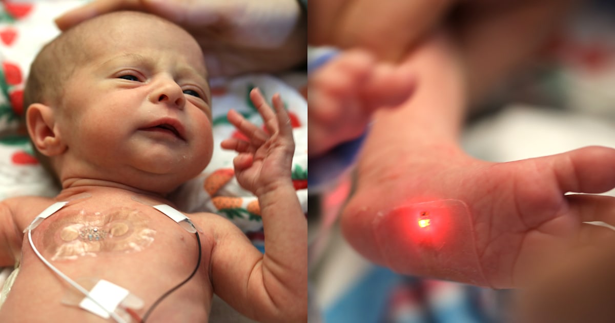 Wireless sensors allow skin-to-skin contact with NICU babies